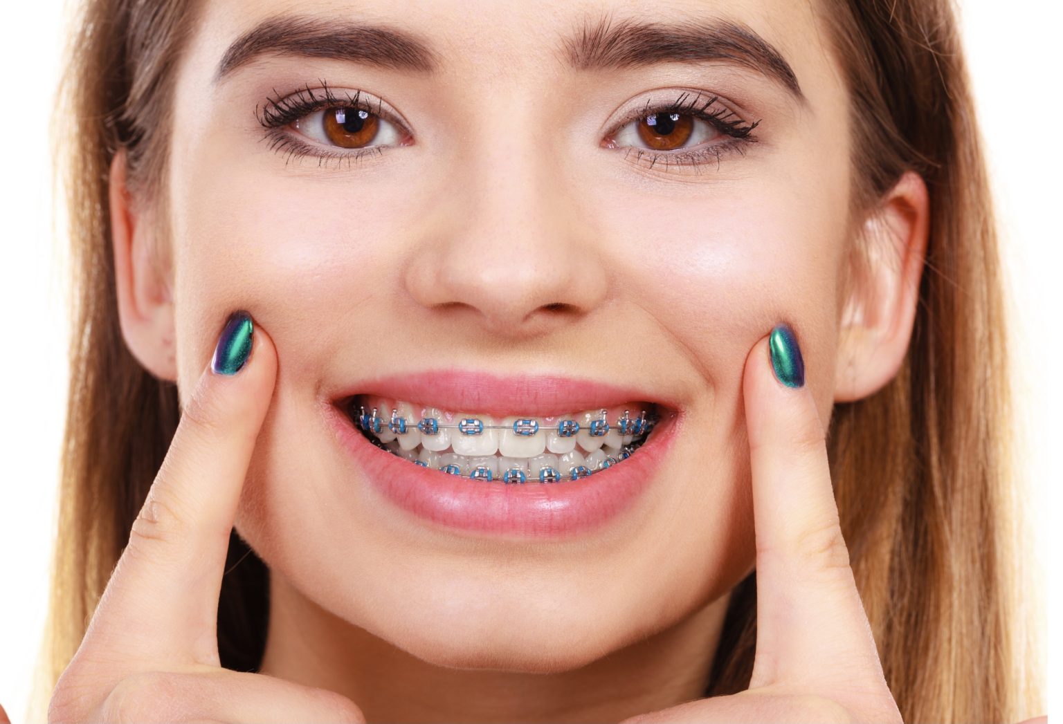 Teeth Whitening After Braces - Should I Get My Teeth Whitened ...