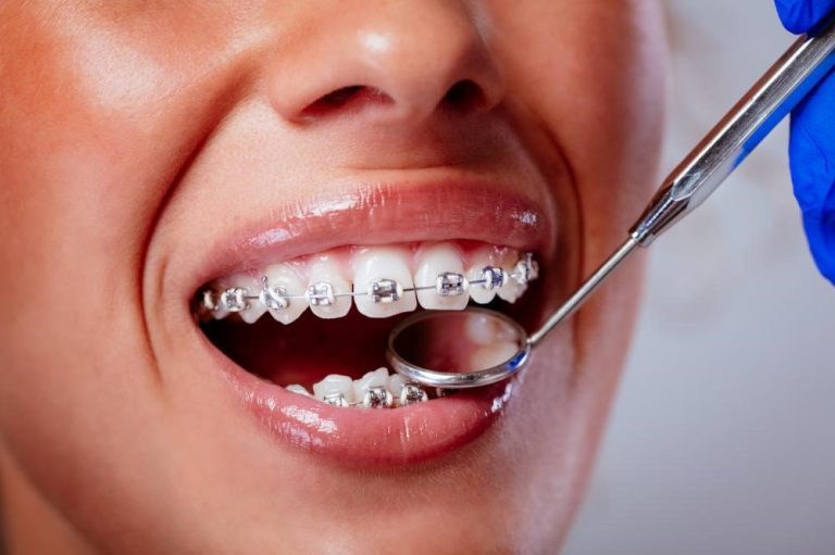 Cost of Braces in 2025 | PretoriaSmile Orthodontics