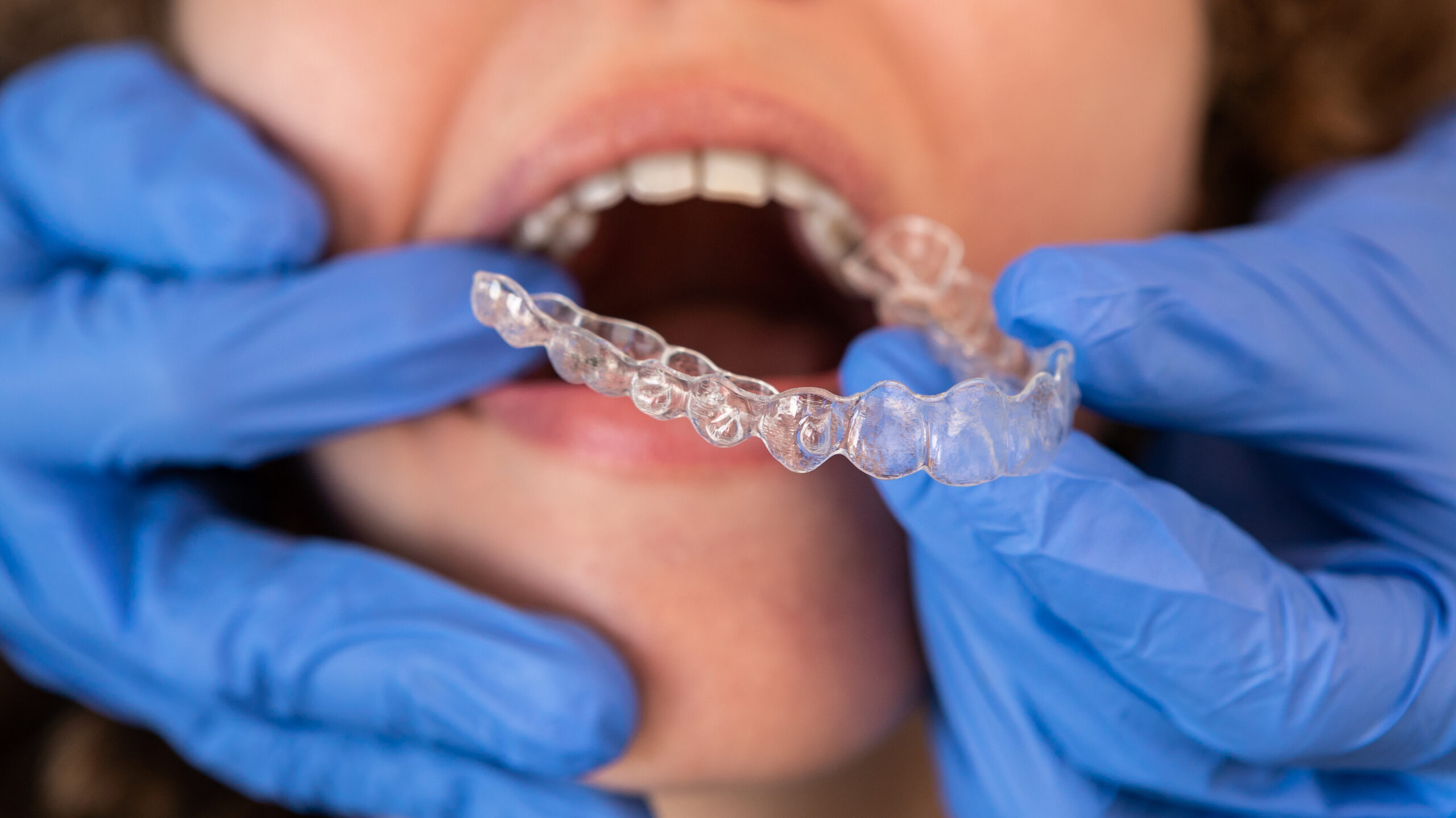 Aligners vs. Retainers: What’s the Difference? | PretoriaSmile